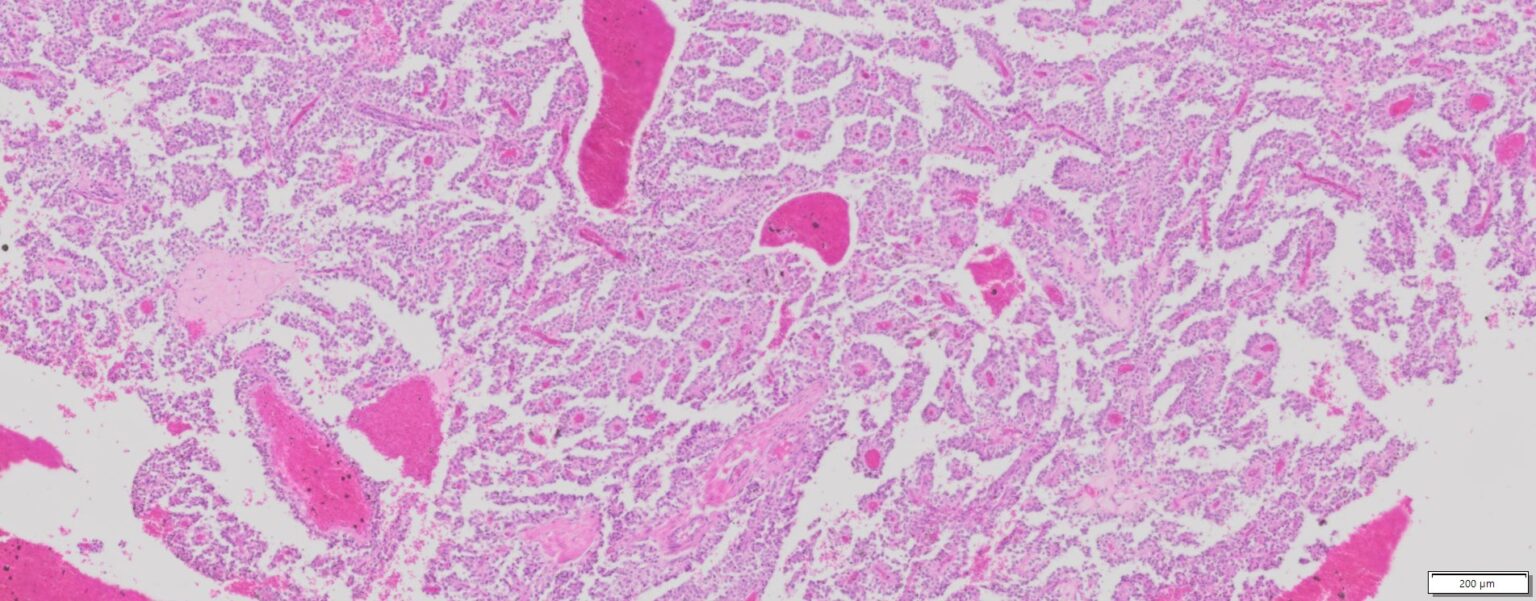 Human Pancreas Cancer (Neuroendocrine Tumor) FFPE Sections