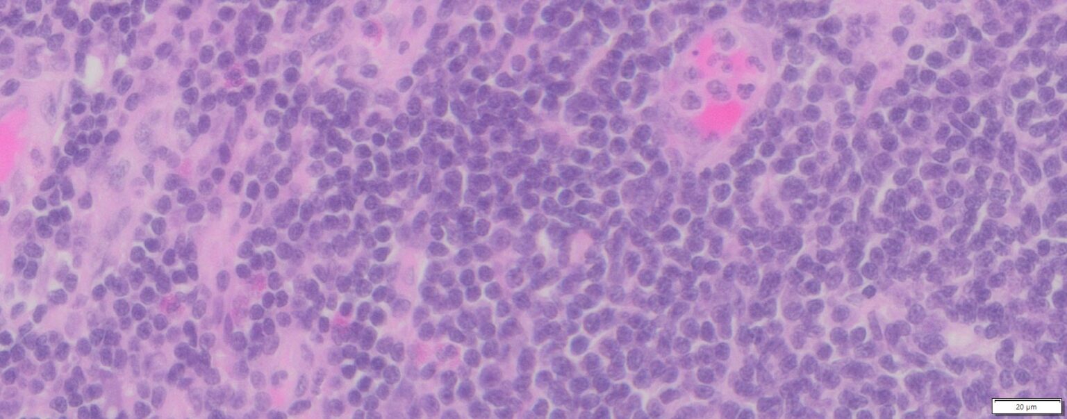 Human Classic Hodgkin's lymphoma FFPE Sections