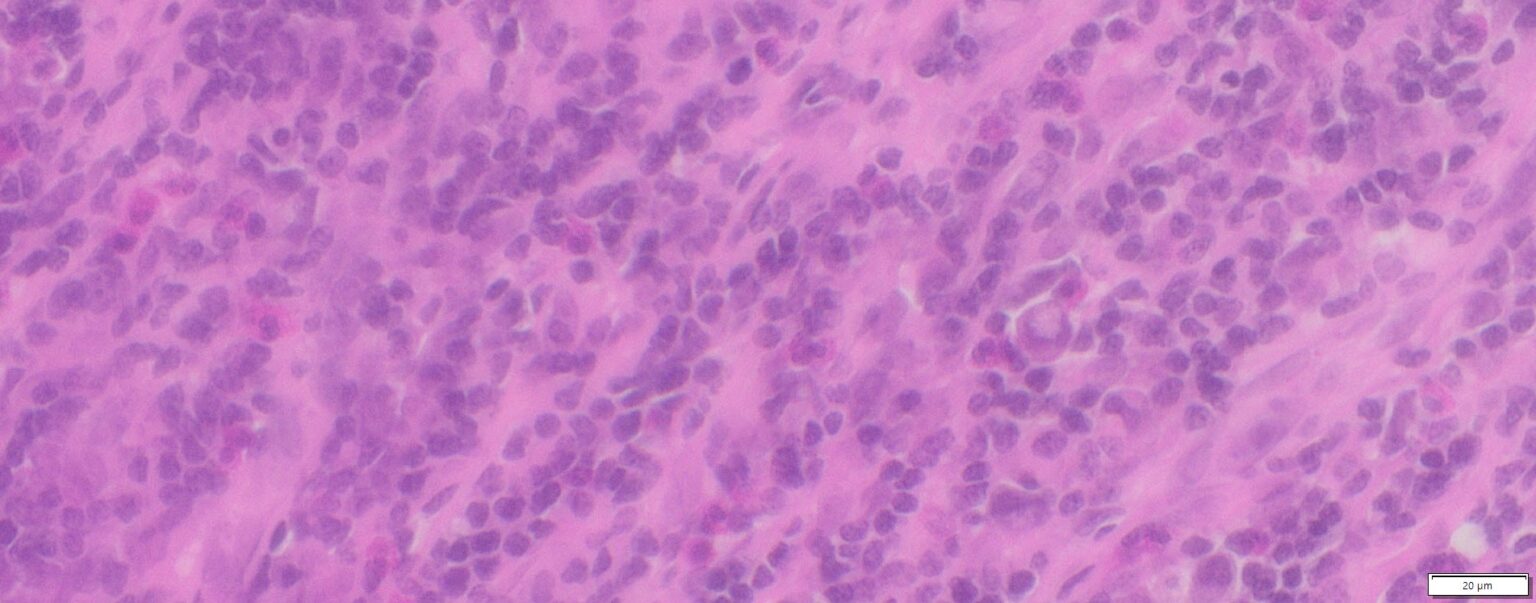 Human Classic Hodgkin's lymphoma FFPE Sections