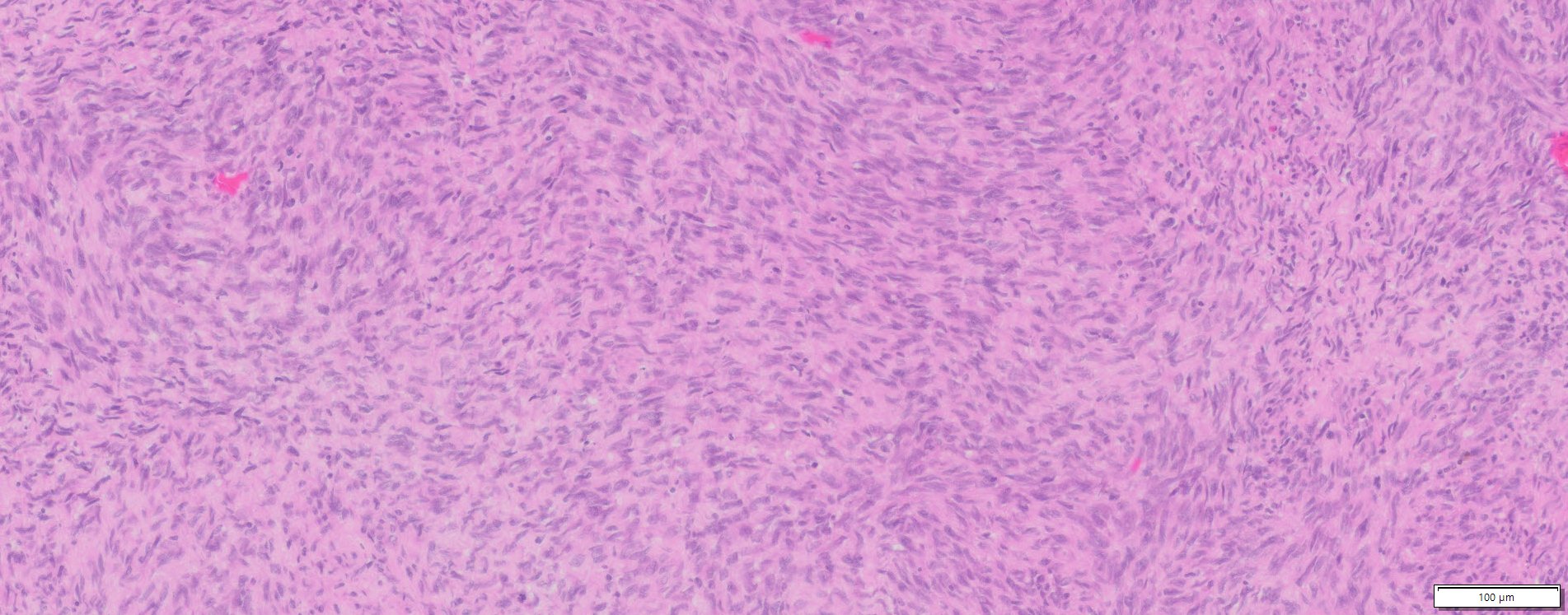 Human Dermatofibrosarcoma of the soft tissues FFPE Sections