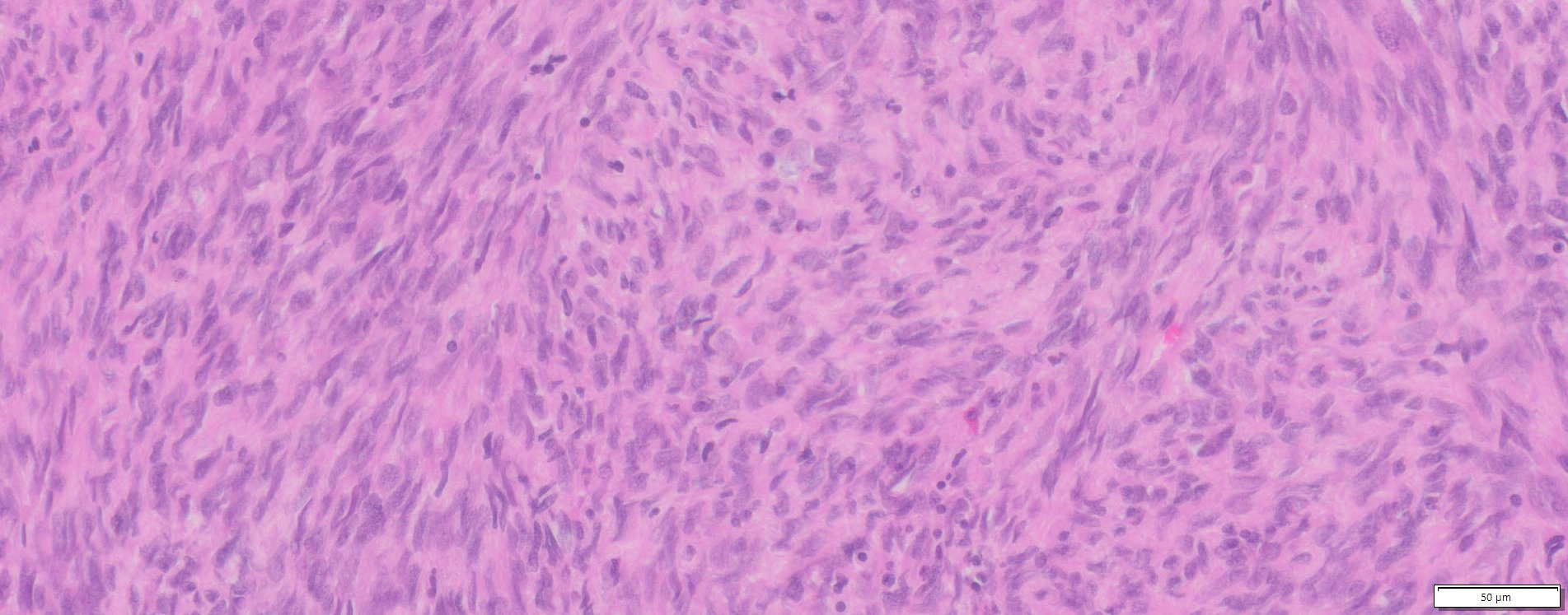 Human Dermatofibrosarcoma of the soft tissues FFPE Sections