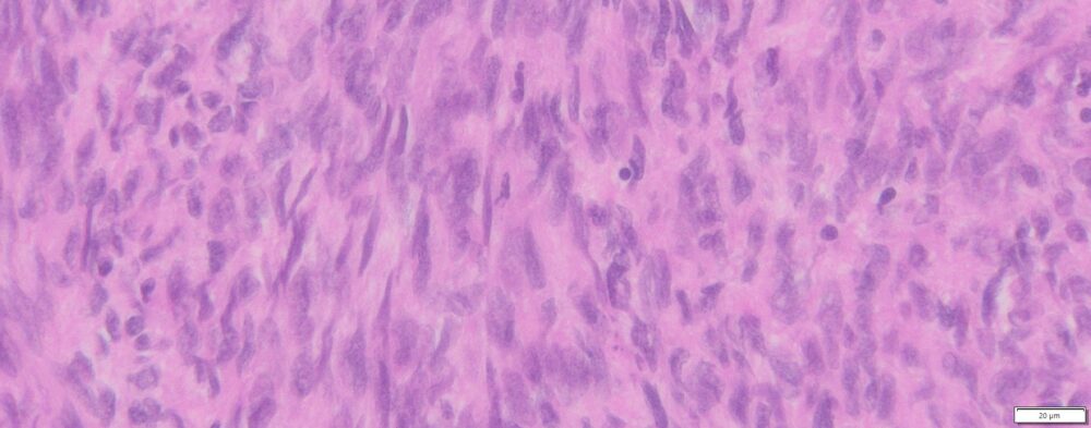 Human Dermatofibrosarcoma of the soft tissues FFPE Sections