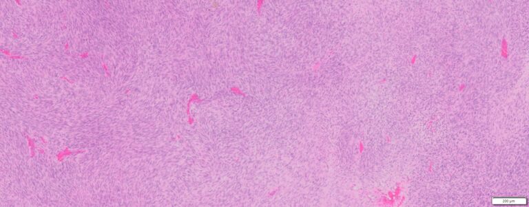Human Dermatofibrosarcoma of the soft tissues FFPE Sections