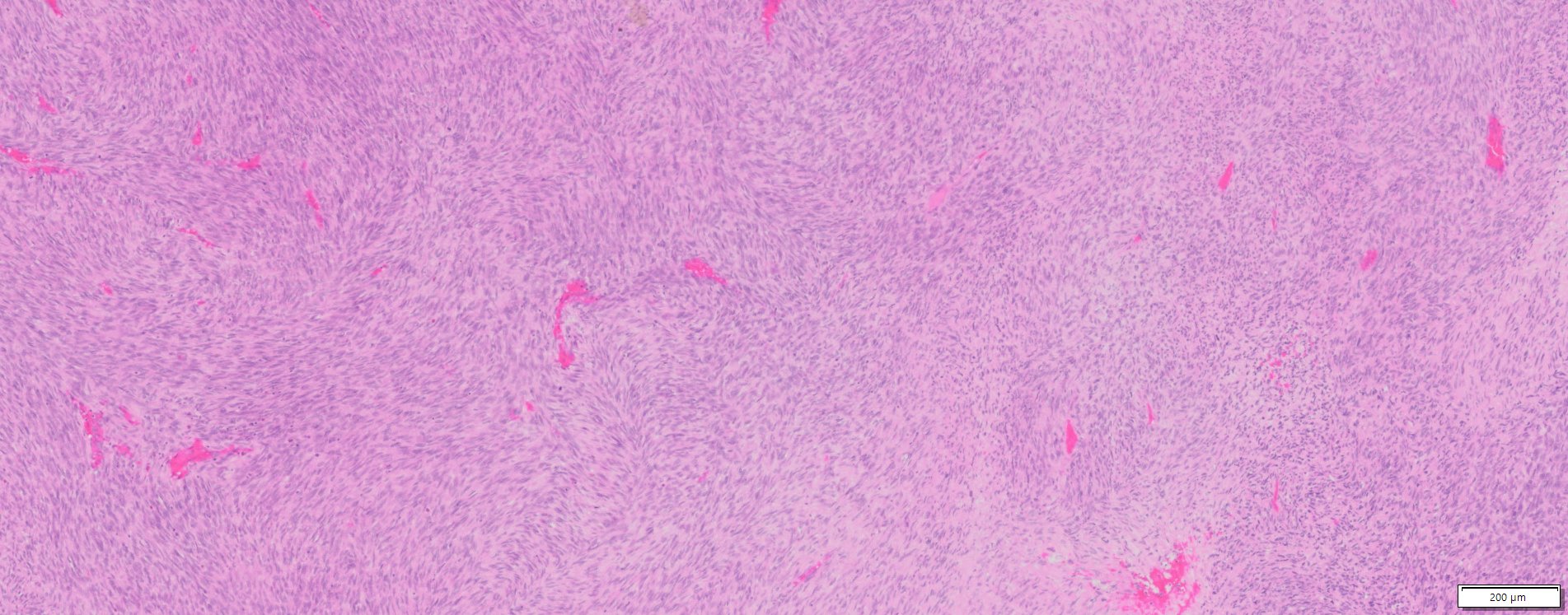 Human Dermatofibrosarcoma of the soft tissues FFPE Sections