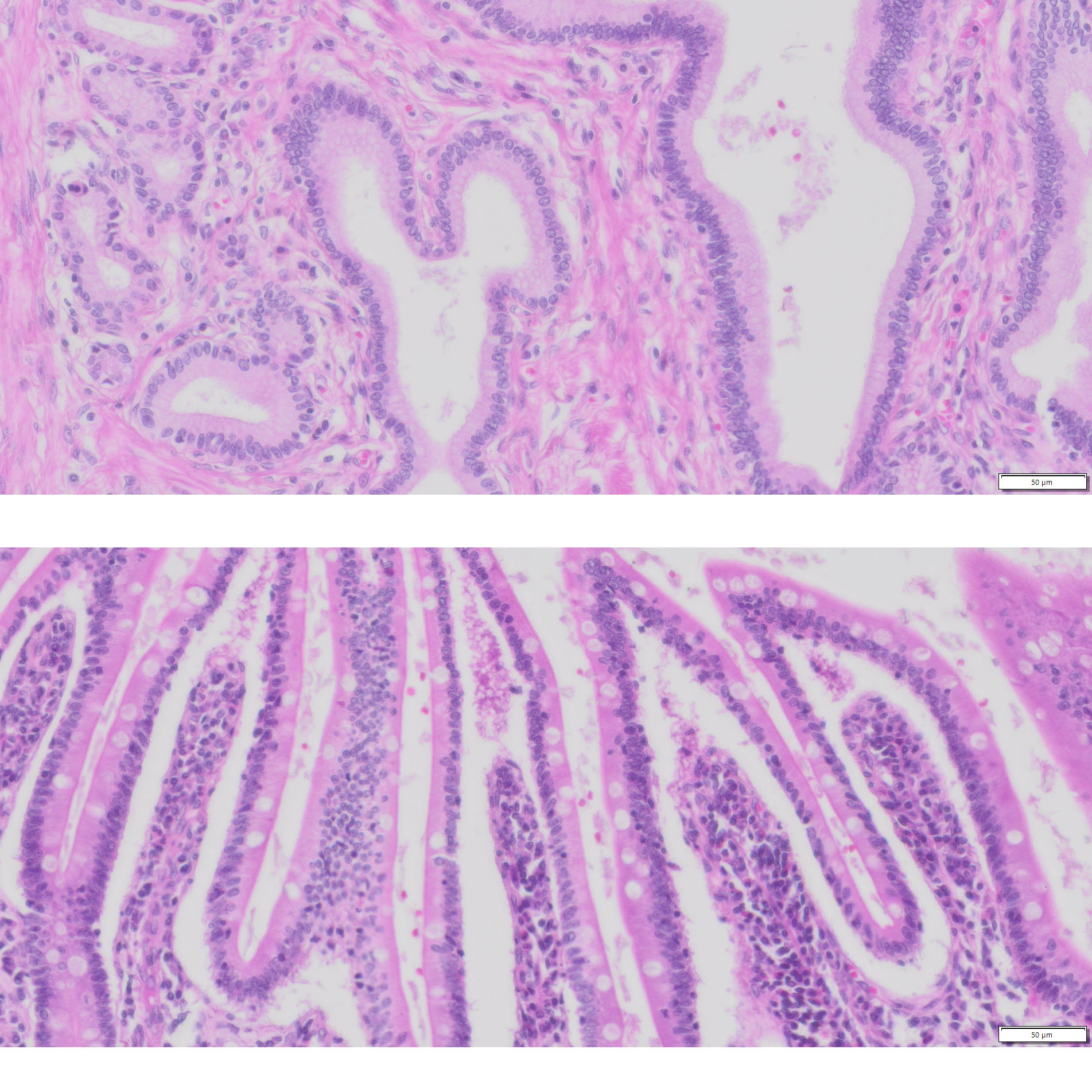 Human Pancreas Adenocarcinoma & Normal Matched Pair Tissue FFPE Sections