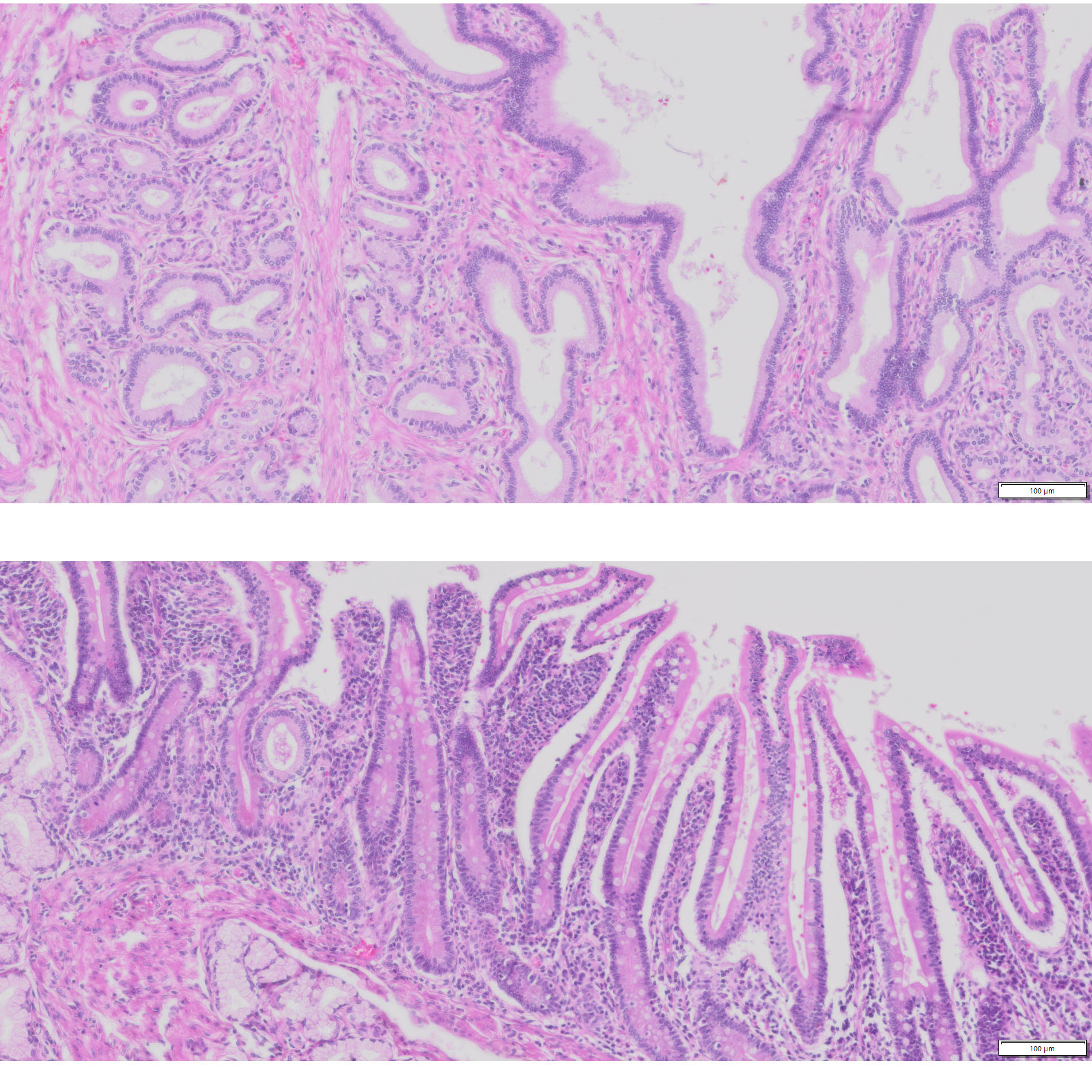 Human Pancreas Adenocarcinoma & Normal Matched Pair Tissue FFPE Sections