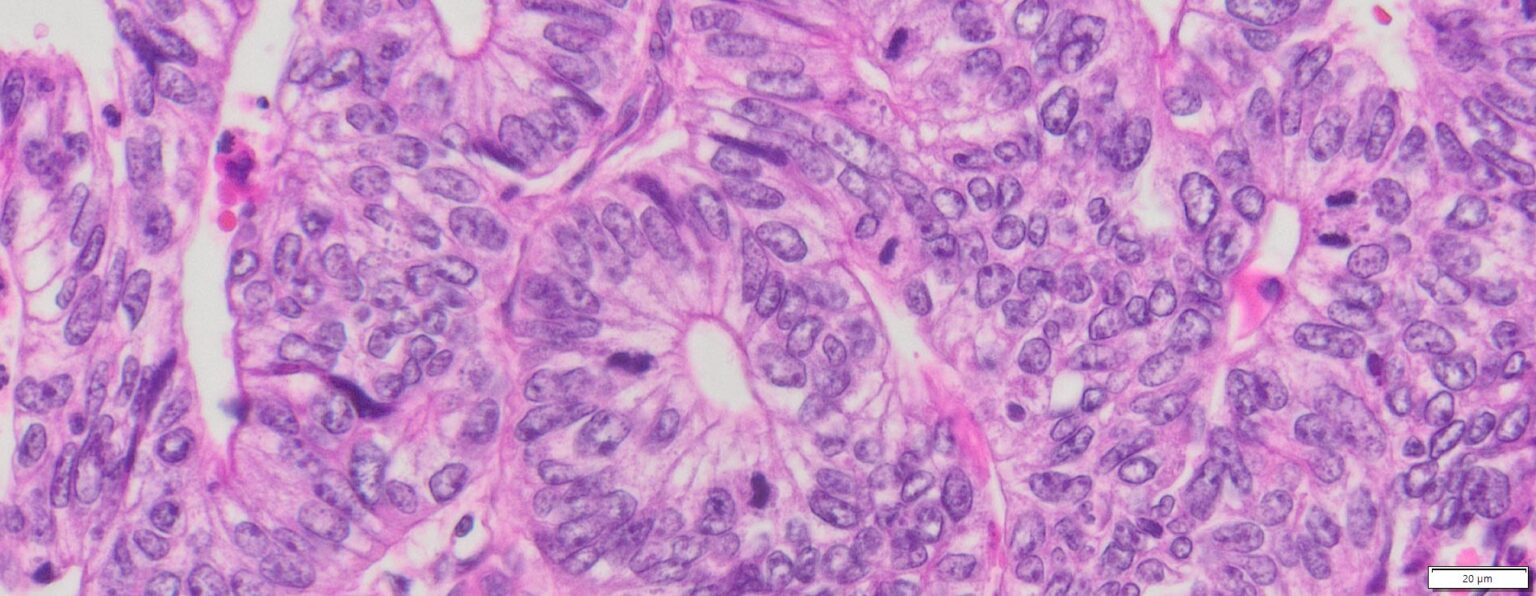 Human Colon Adenocarcinoma FFPE Sections