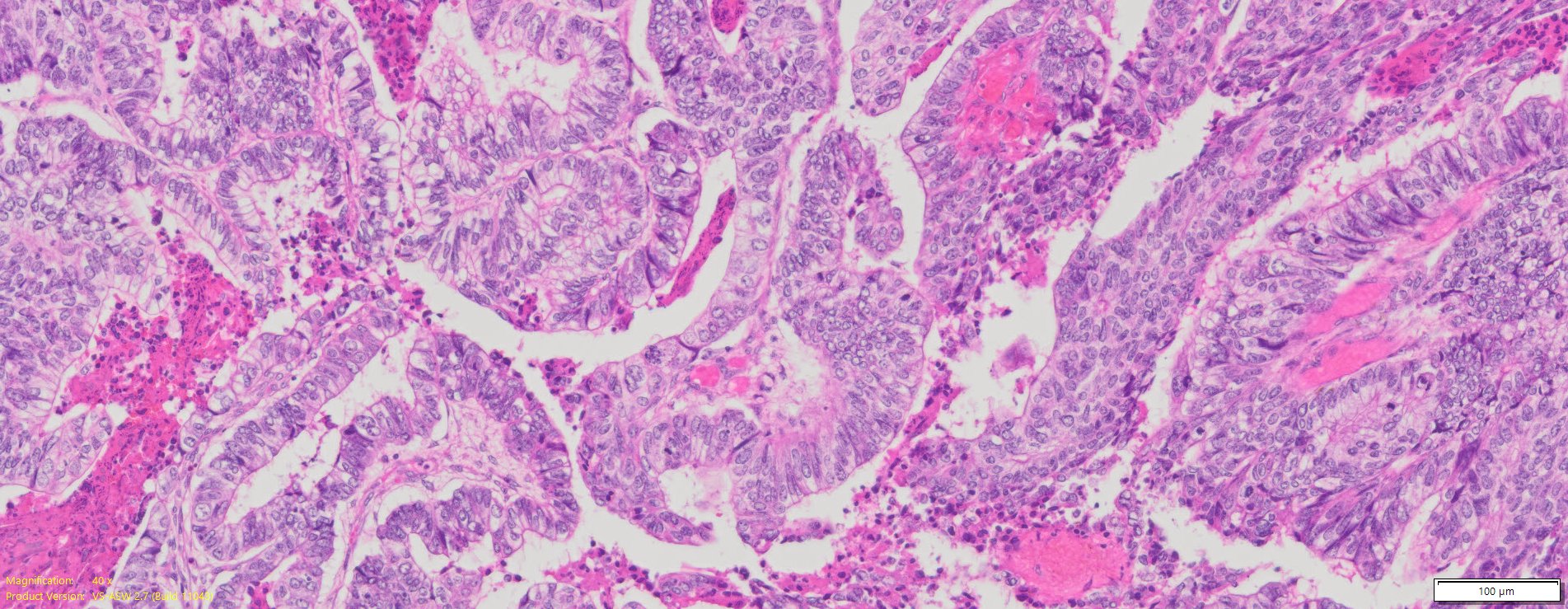 Human Colon Adenocarcinoma FFPE Sections