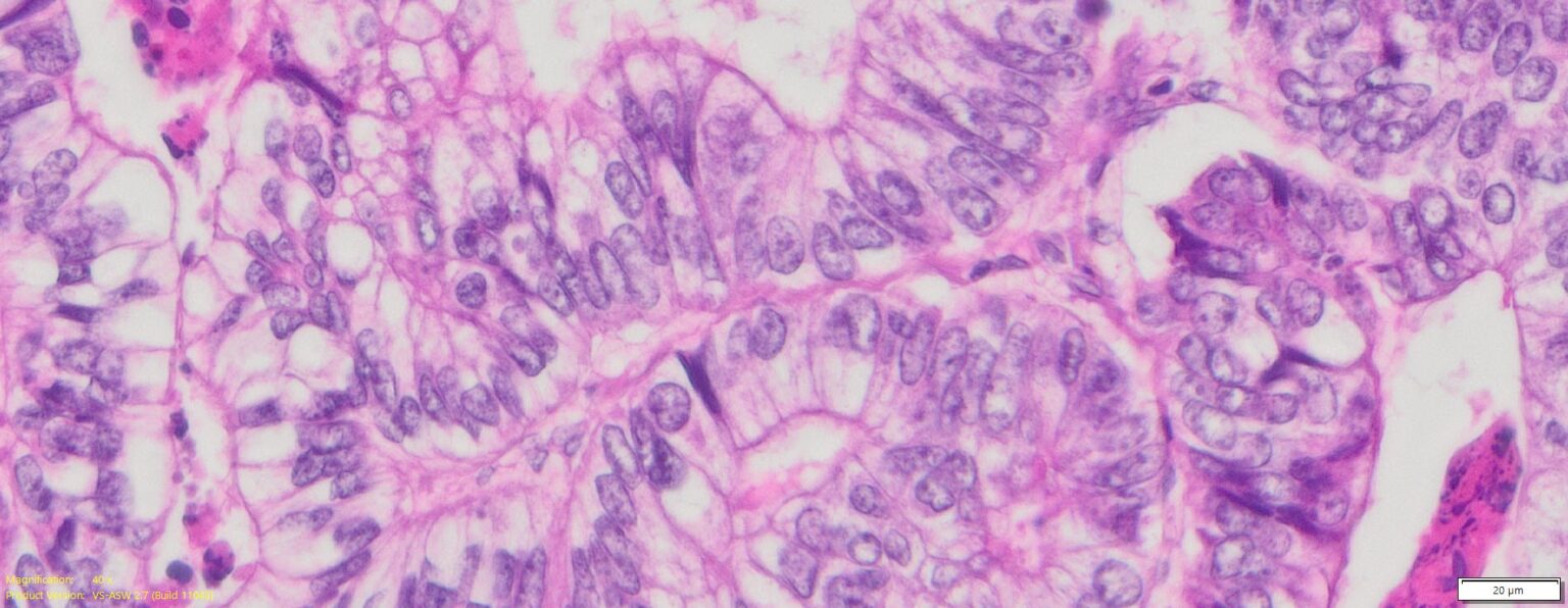 Human Colon Adenocarcinoma FFPE Sections