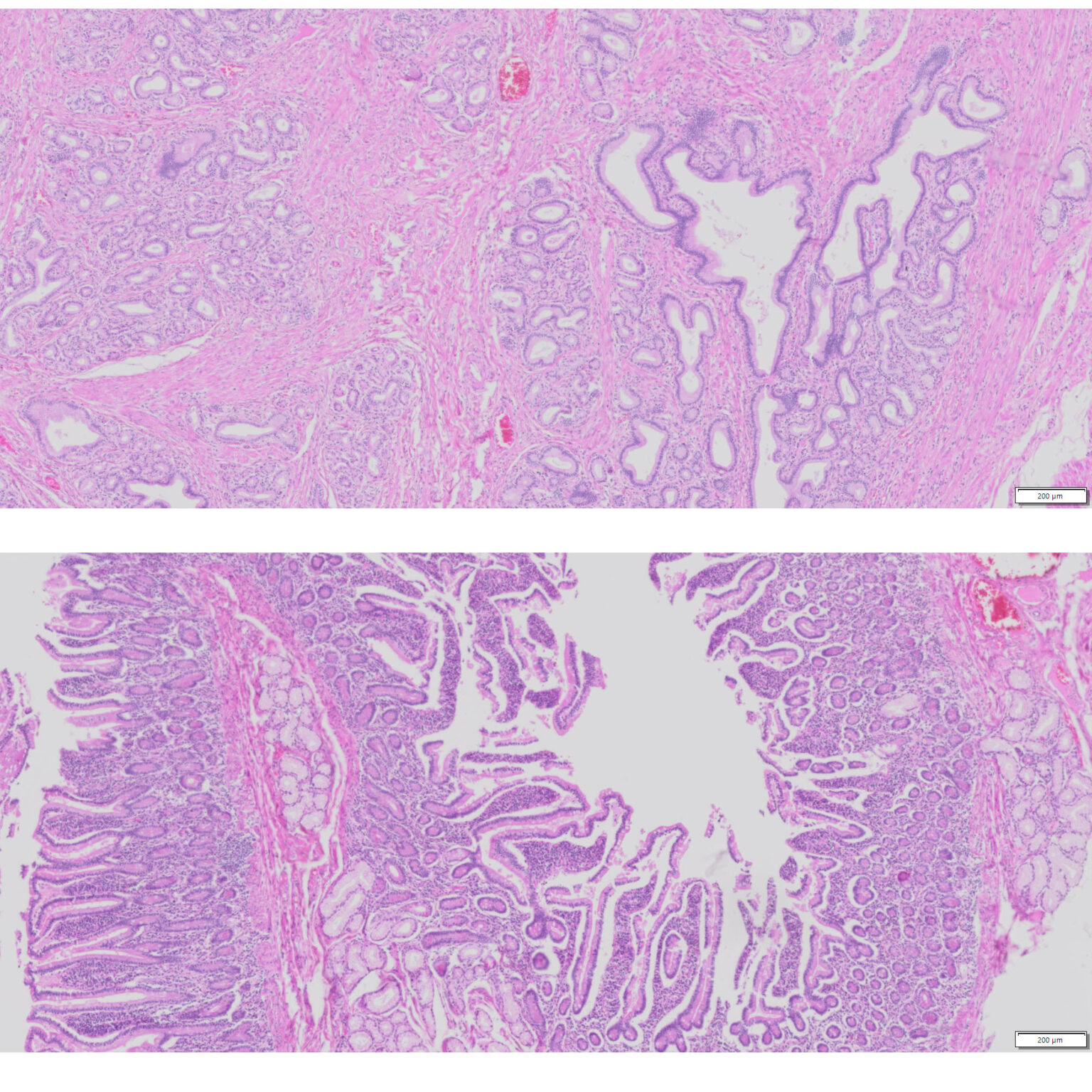 Human Pancreas Adenocarcinoma & Normal Matched Pair Tissue FFPE Sections