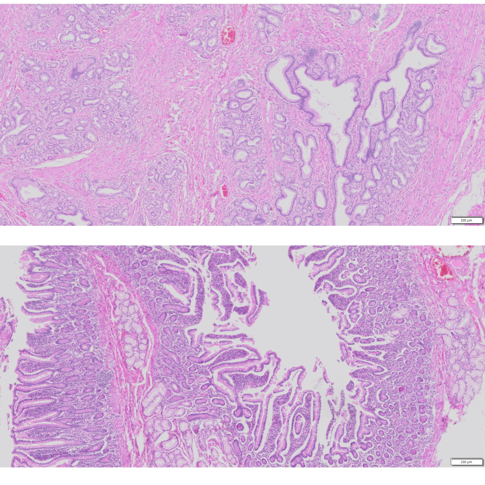 Human Pancreas Adenocarcinoma & Normal Matched Pair Tissue FFPE Sections