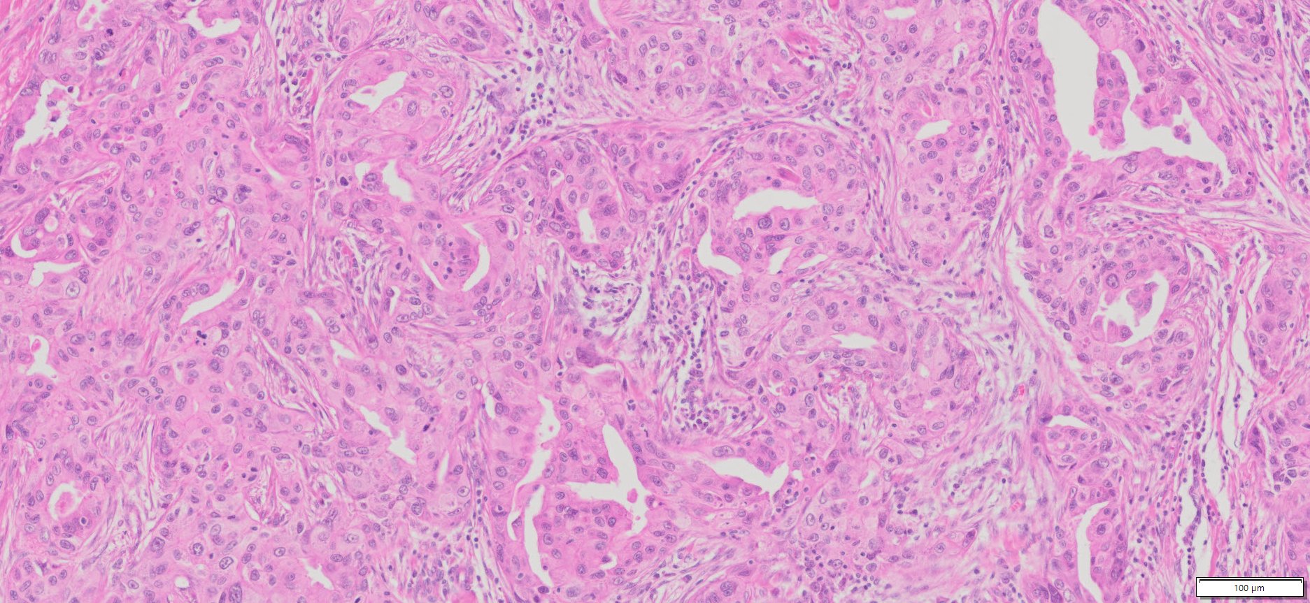 Human Breast Cancer (Invasive ductal carcinoma ) FFPE Sections