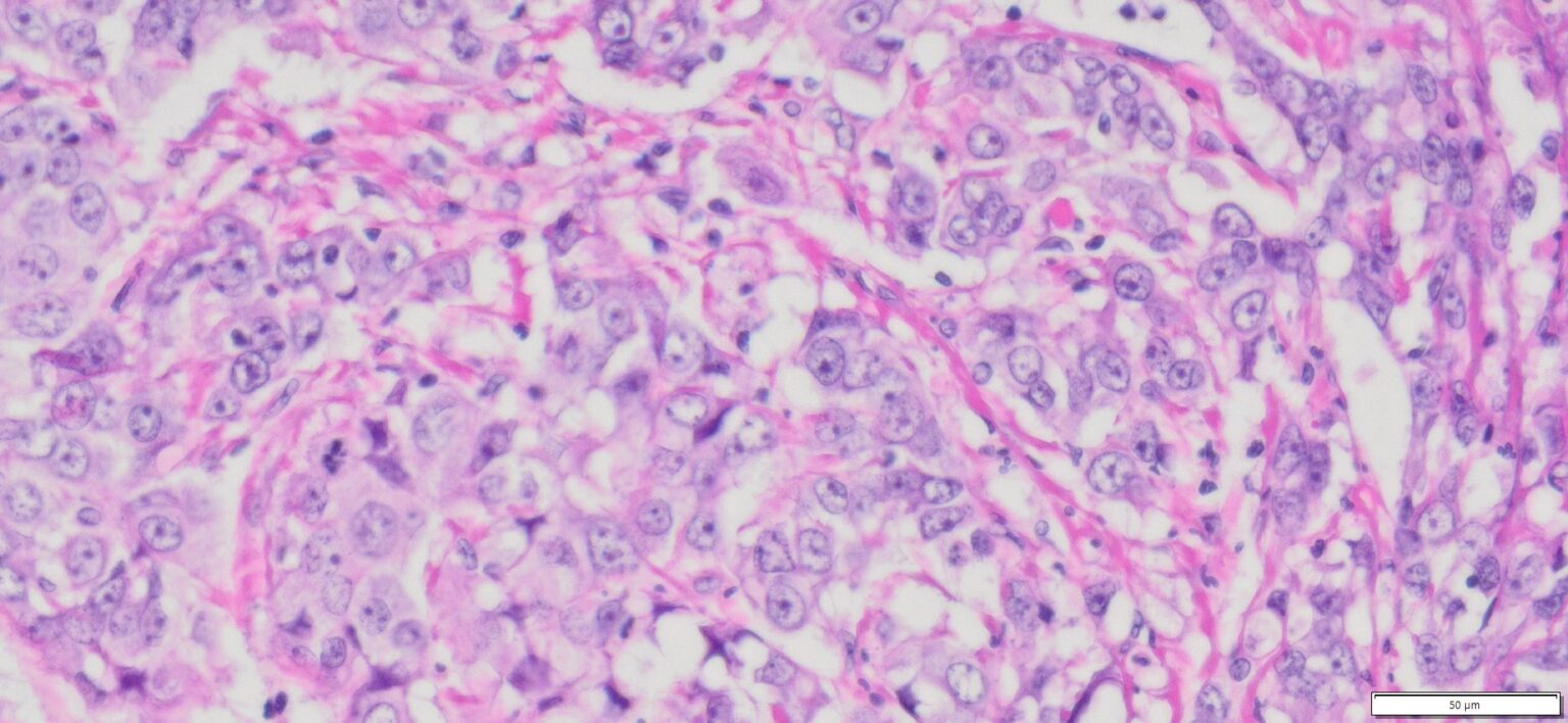 Human Breast Cancer (ER(+/-)/PR-/Her2-), (Invasive ductal carcinoma ...