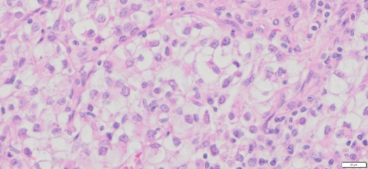 Human Clear Cell Renal Cell Carcinoma FFPE Sections