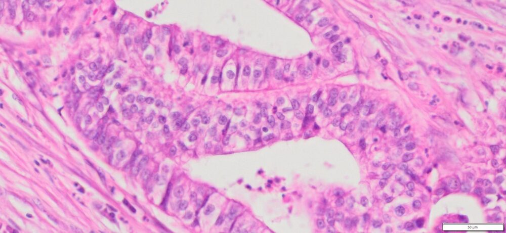 Human Pancreatic ductal adenocarcinoma FFPE Sections
