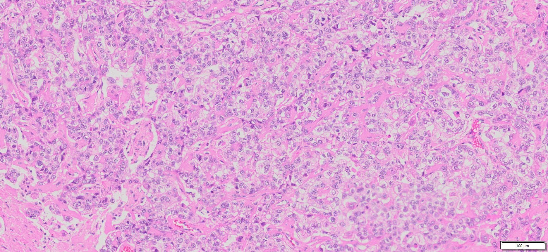 Human Ovarian Clear-Cell Carcinoma FFPE Sections