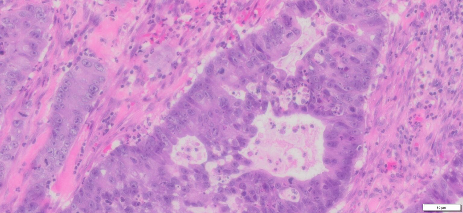 Human Cervical Adenocarcinoma FFPE Sections