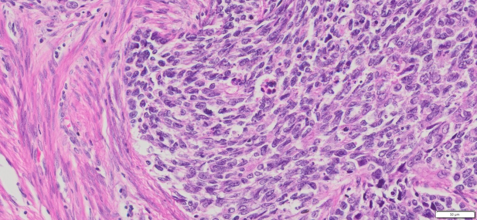 Human Endometrial Carcinosarcoma FFPE Sections