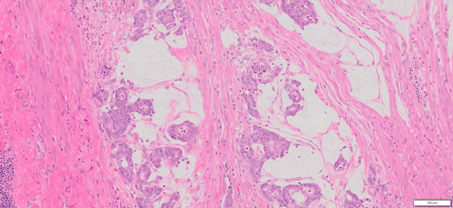 Human Appendix Mucinous Adenocarcinoma FFPE Sections