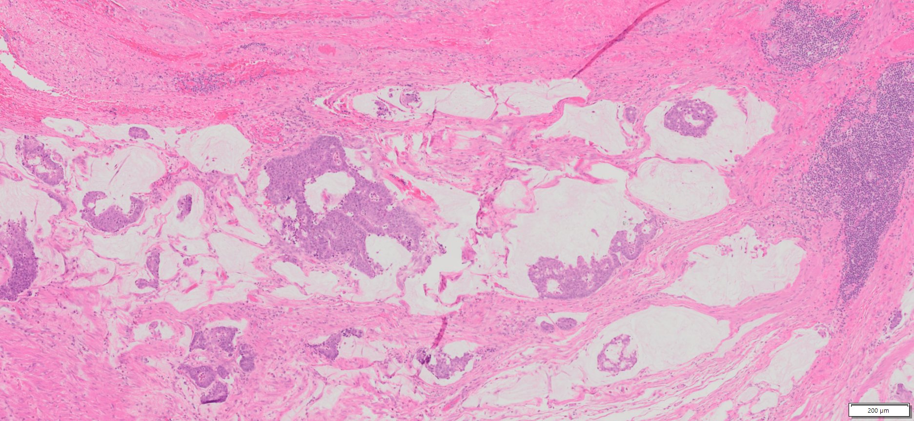 Human Appendix Mucinous Adenocarcinoma FFPE Sections