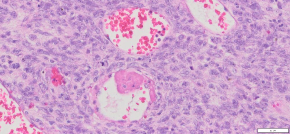 Human Adult Pelvic Granulosa Cell Tumor FFPE Sections