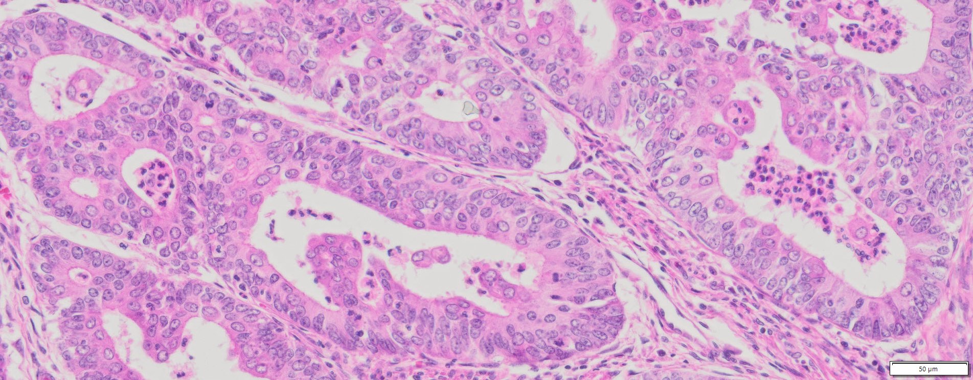 Human Endometrioid Adenocarcinoma FFPE Sections